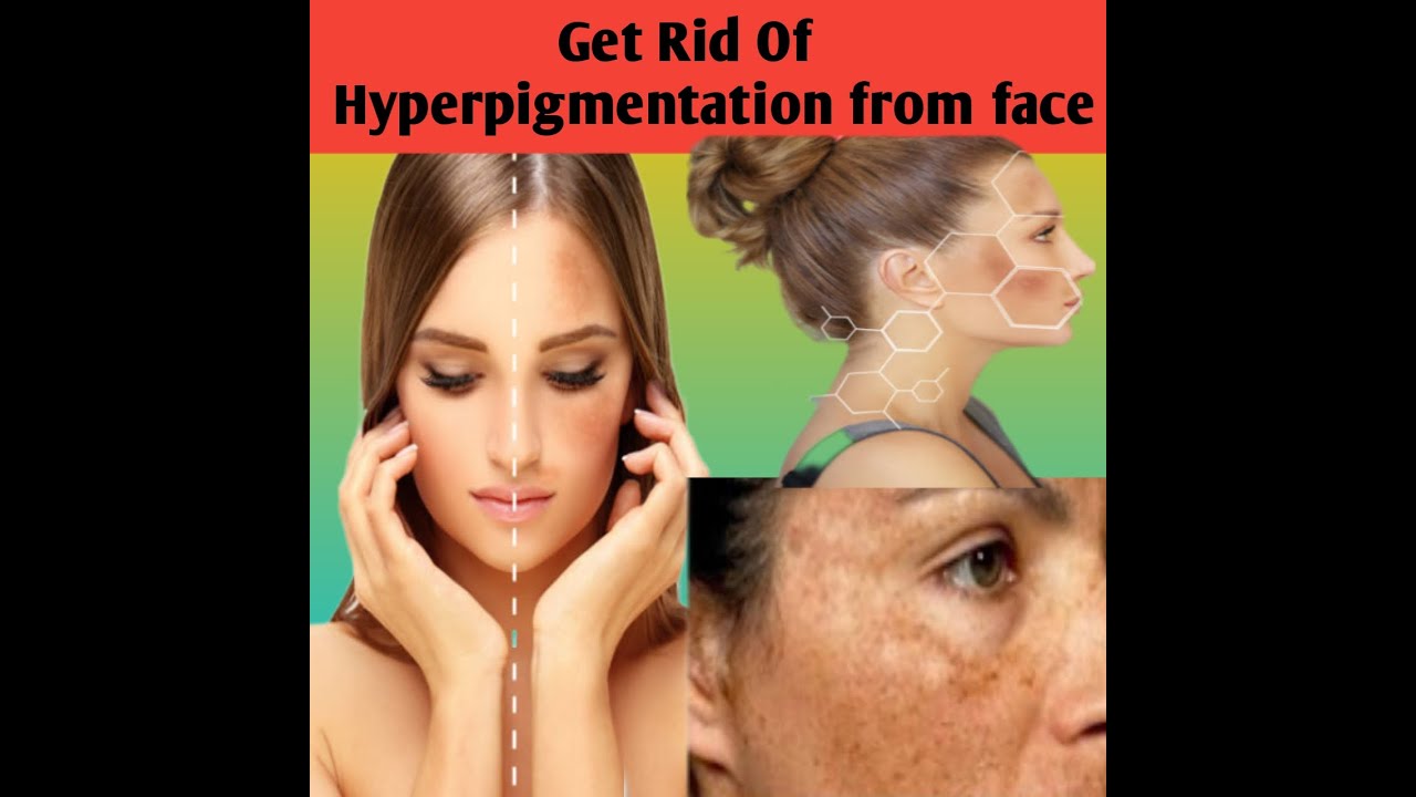 Get rid of hyperpigmentation and dark spot - YouTube