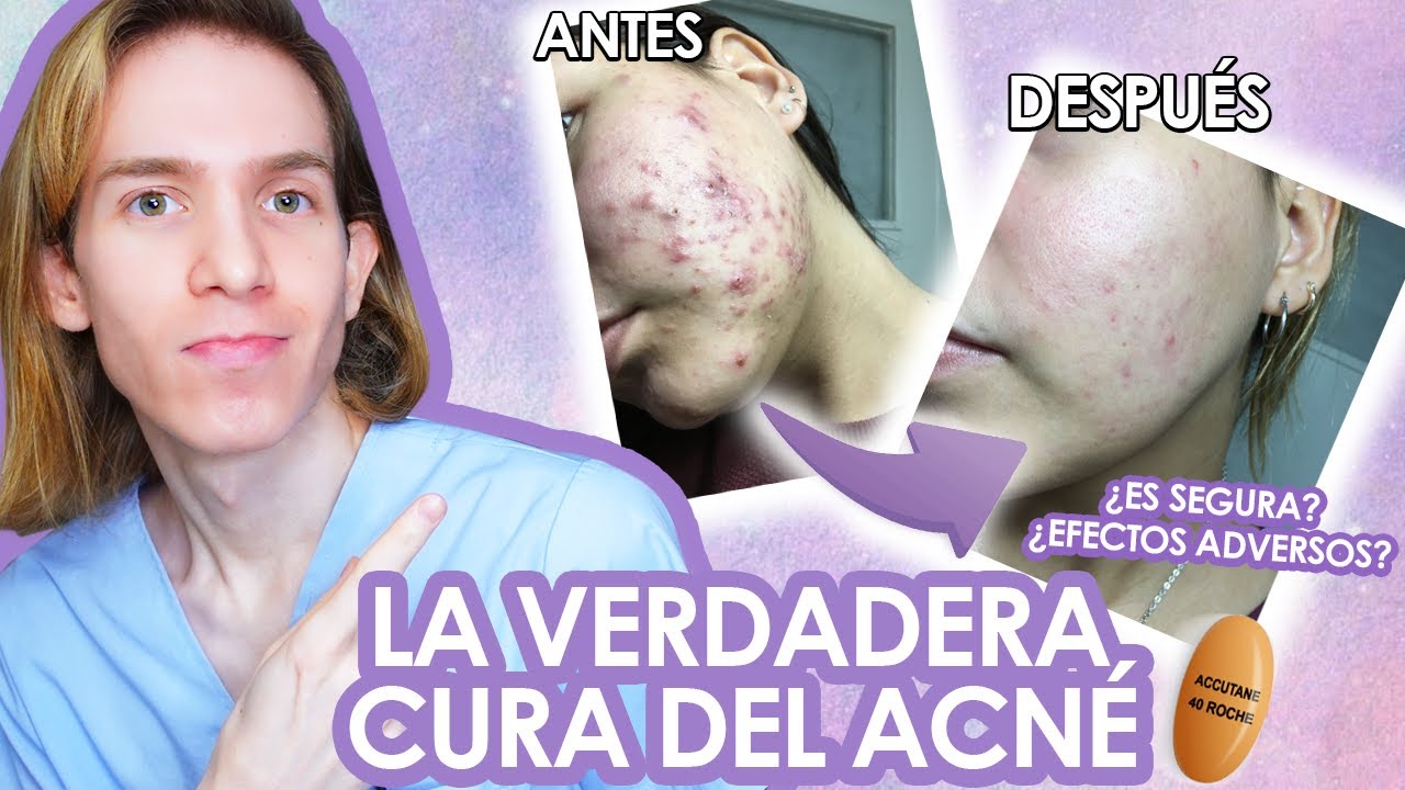ROACCUTAN o ACCUTANE: Efectos adversos, como tomarla, antes y despues ...