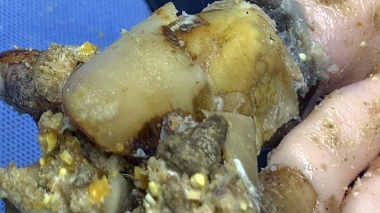 Ingrown nails are long and curly, The ingrown nails are curled like ...