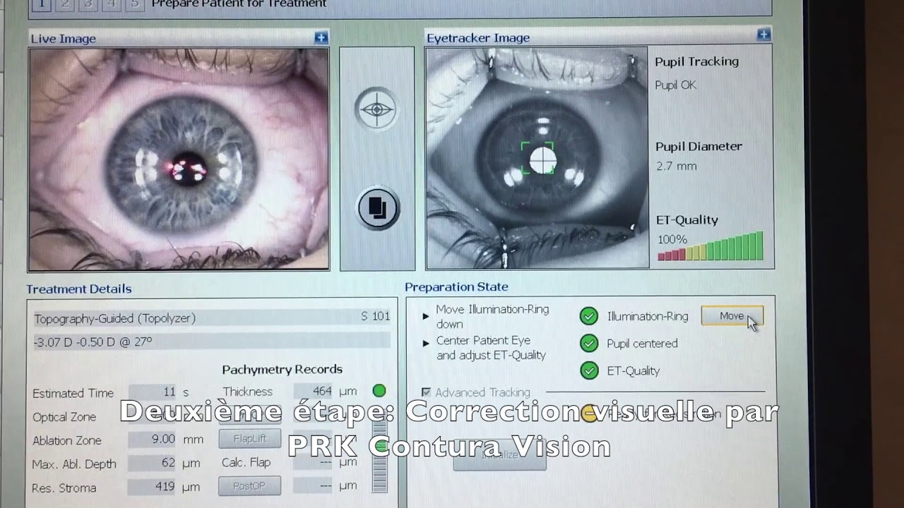 Trans PRK Topoguided Contoura Vision (technique no touch 100% laser ...