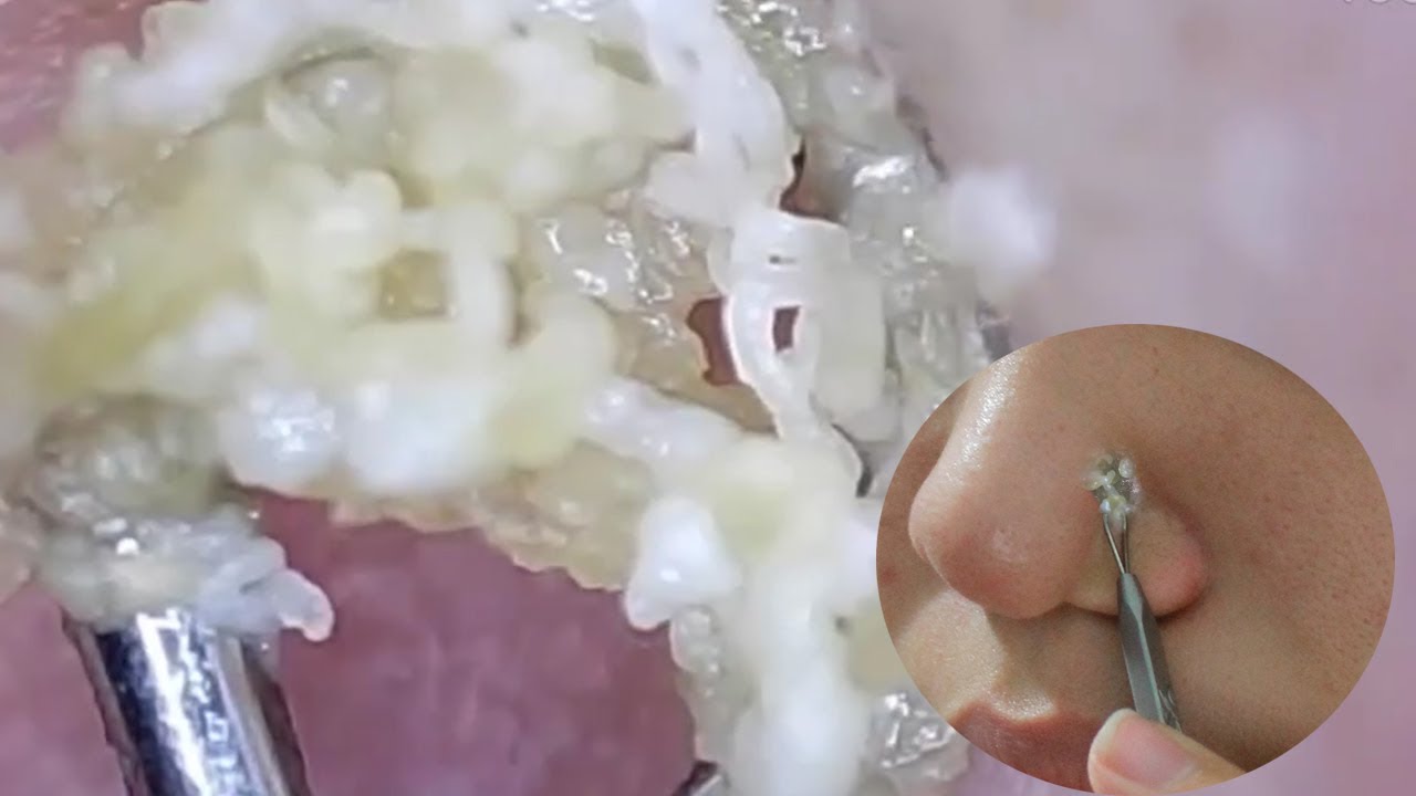 How To Remove Blackheads From Nose At Home Satisfying Blackhead 2019