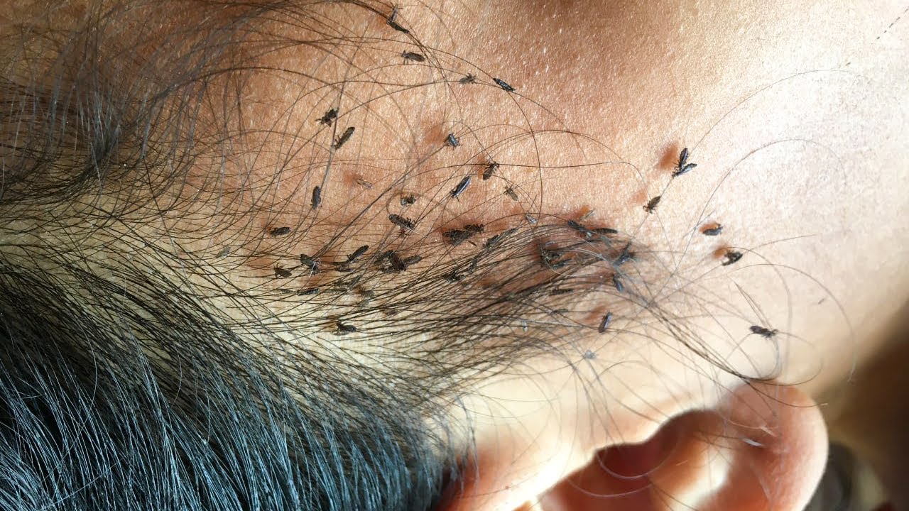 Head lice removing from head - How to get rid a lot of head lice - YouTube
