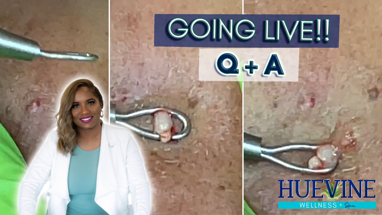 The Holy Trinity for Acne Scarring - YouTube