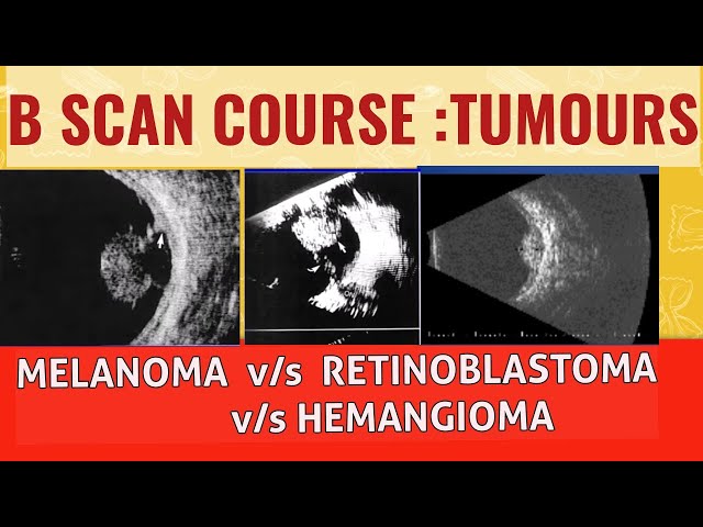 Choroidal Melanoma Choroidal Melanoma