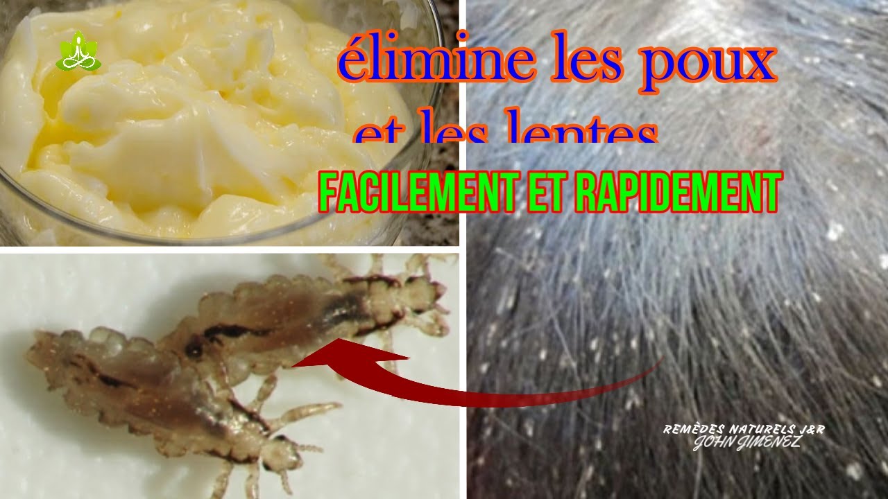 ÉLIMINEZ LES POUX ET LES LENTES RAPIDEMET ET FACILEMENT. - YouTube
