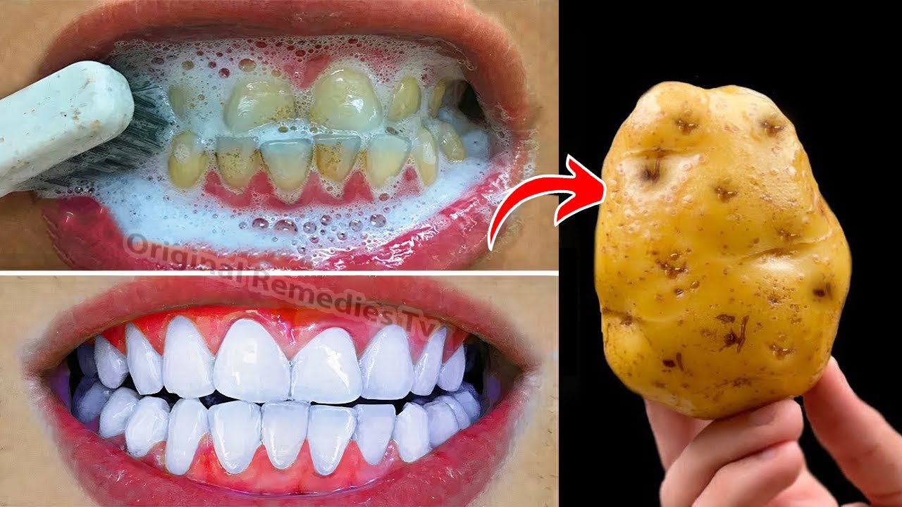 Every Dentist Hide This Shocking Secret! A Potato to Reverse Tooth ...