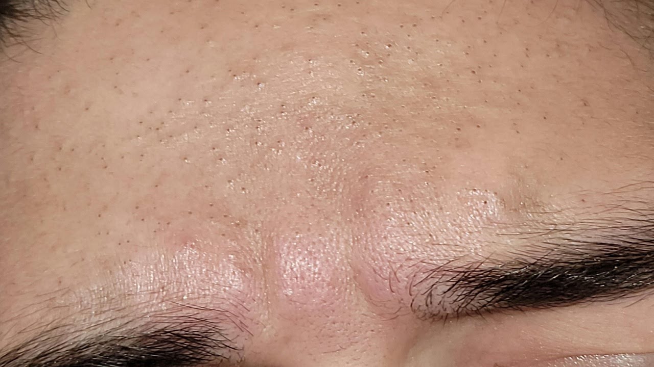 how to get rid of blackheads on forehead permanently - YouTube