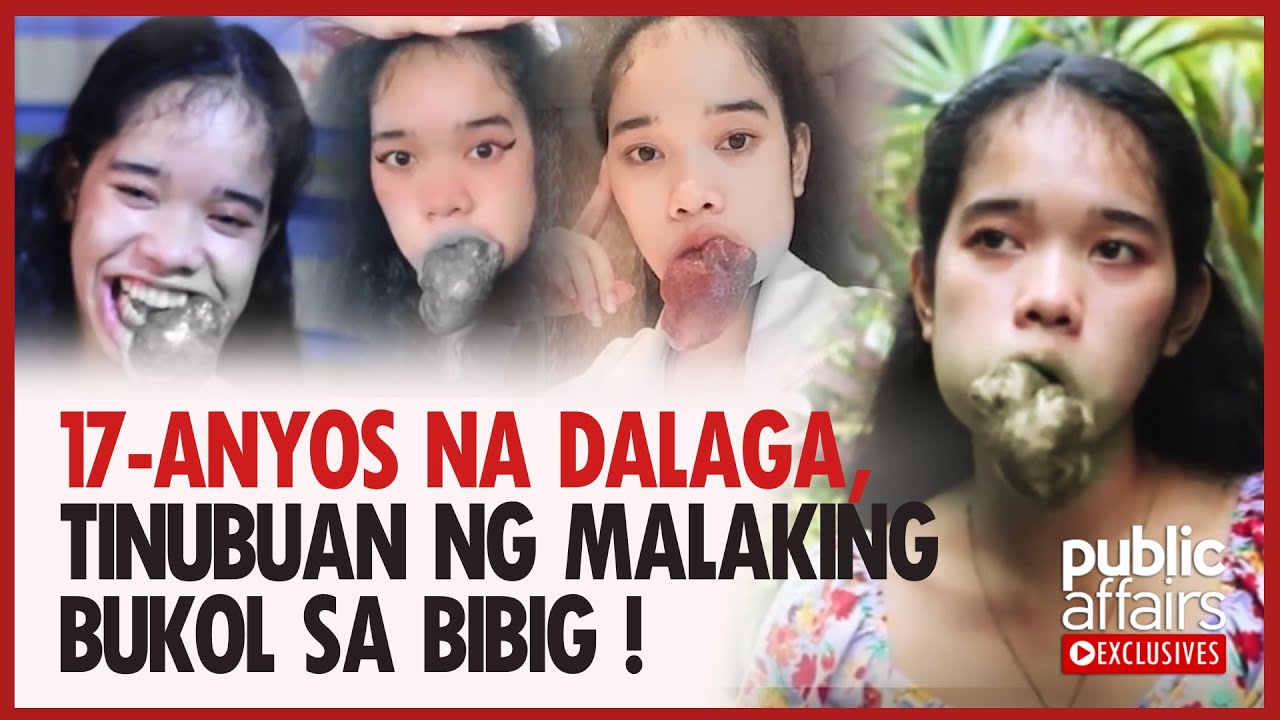 17-anyos na dalaga, tinubuan ng malaking bukol sa bibig | Public ...