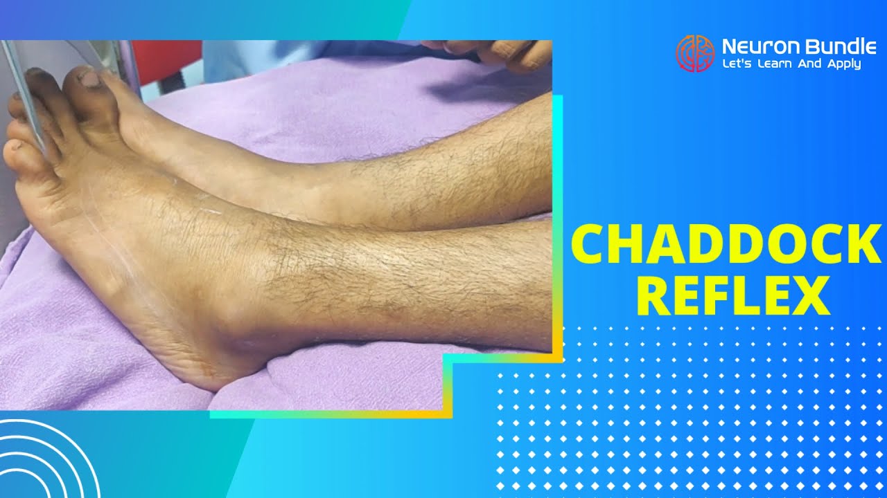 chaddock reflex | an alternative to babinski sign | corticospinal tract ...
