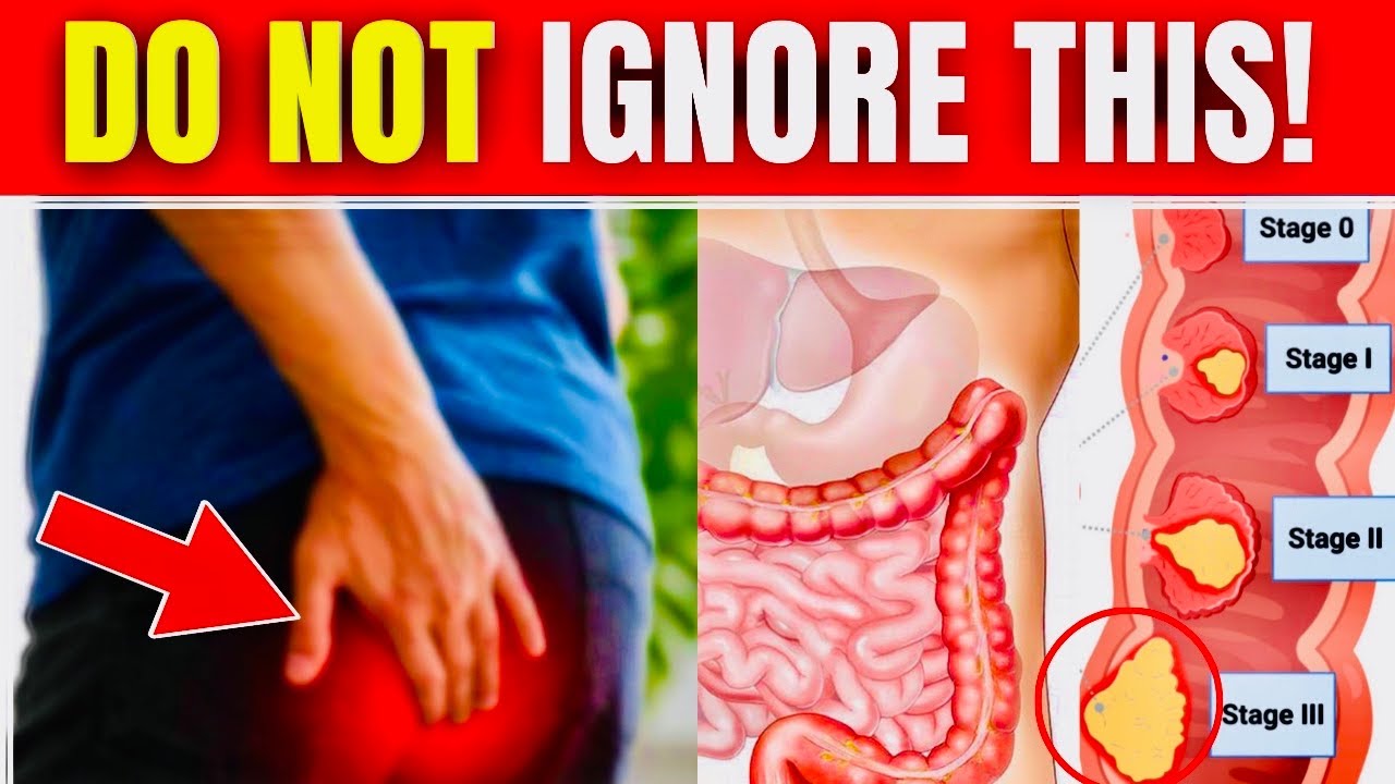 8 EARLY Warning Signs of Colon Cancer you Should NOT IGNORE!⚠️ | Colon ...