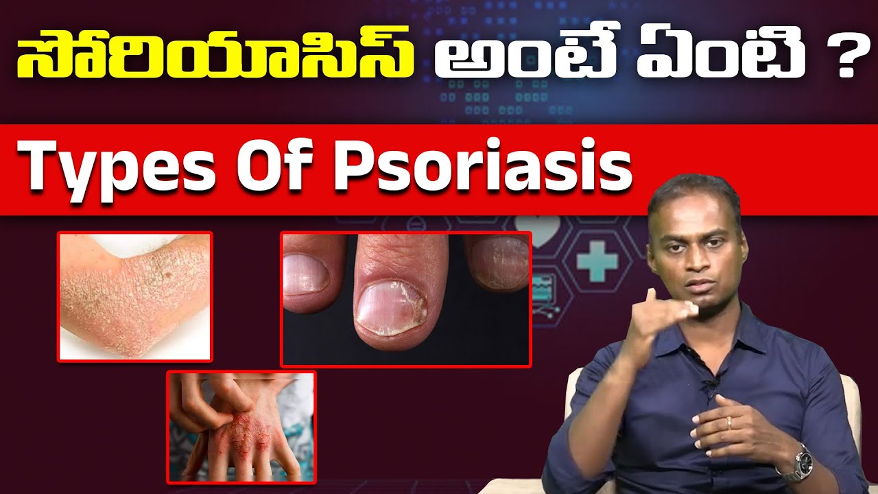 Types Of Psoriasis Soriyas Disease types-of-psoriasis-soriyas-disease