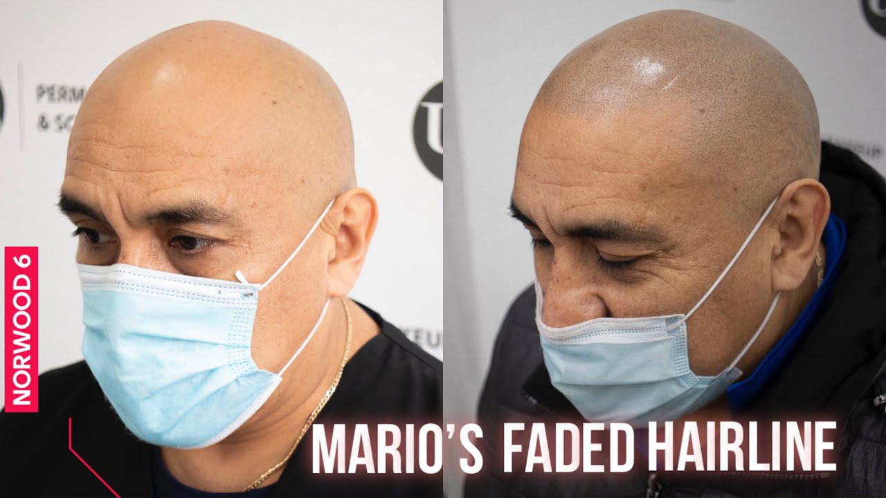 Mario’s Faded Hairline done using Scalp Micropigmentation - YouTube