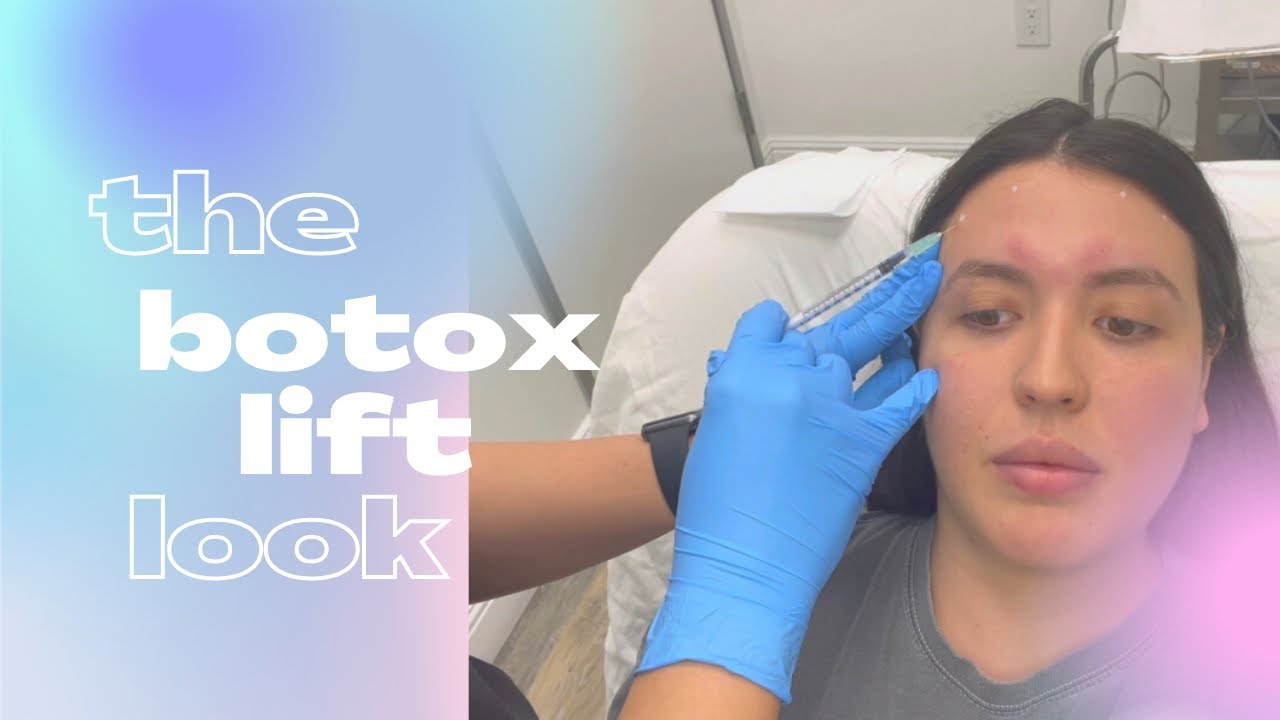 Botox Vlog w/ Before and After Close Ups | LaserAway - YouTube