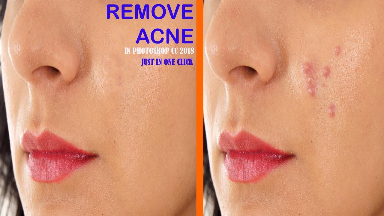 How To Remove Acne In Photoshop L Tutorials Tuts YouTube how-to-remove-acne-in-photoshop-l-tutorials-tuts-youtube