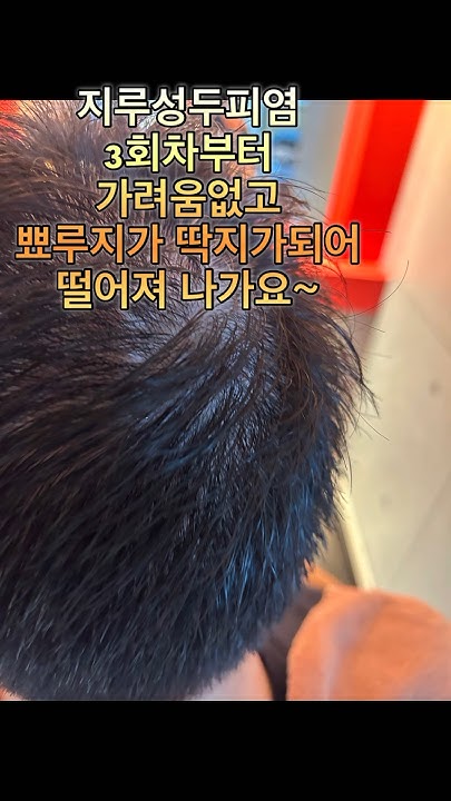 지루성두피관리는 탄산수헤드스파가 정답입니다 지루성두피 헤드스파 두피스켈링 Youtube