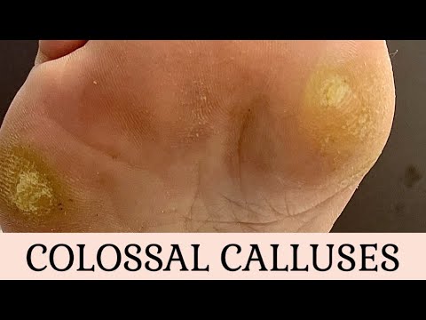 RELAXING DEBRIDEMENT OF TWO COLOSSAL CALLUSES ** BRING THE PILLOW - YouTube