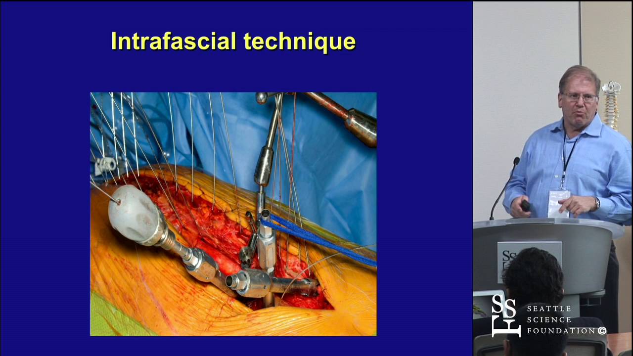 Posterior MIS Thoracolumbar Decompression and Instrumentation by Mark ...
