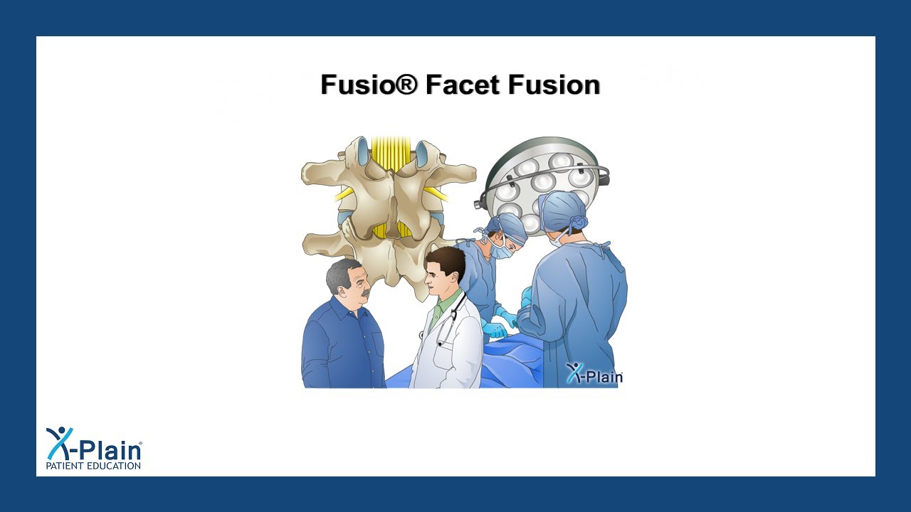 Fusio® Facet Fusion - YouTube