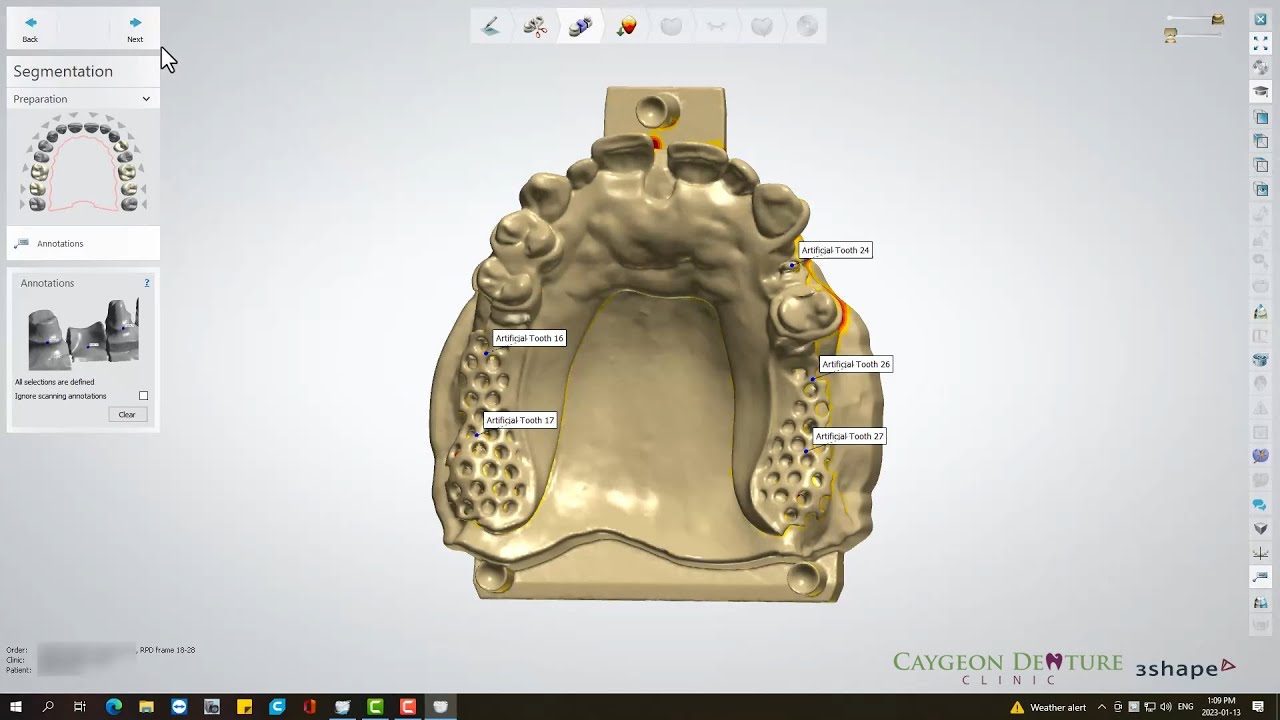 Cast Partial Upper Denture Design - YouTube