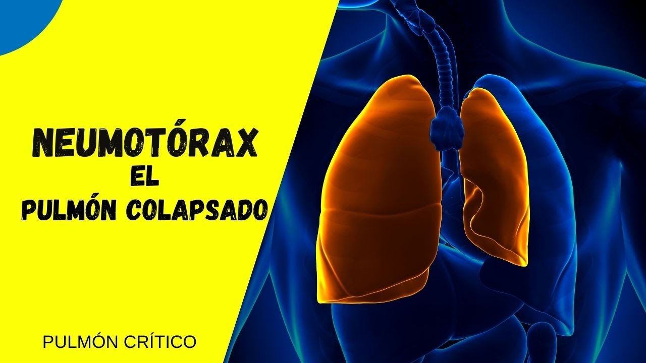 Neumotórax, el pulmón colapsado - YouTube