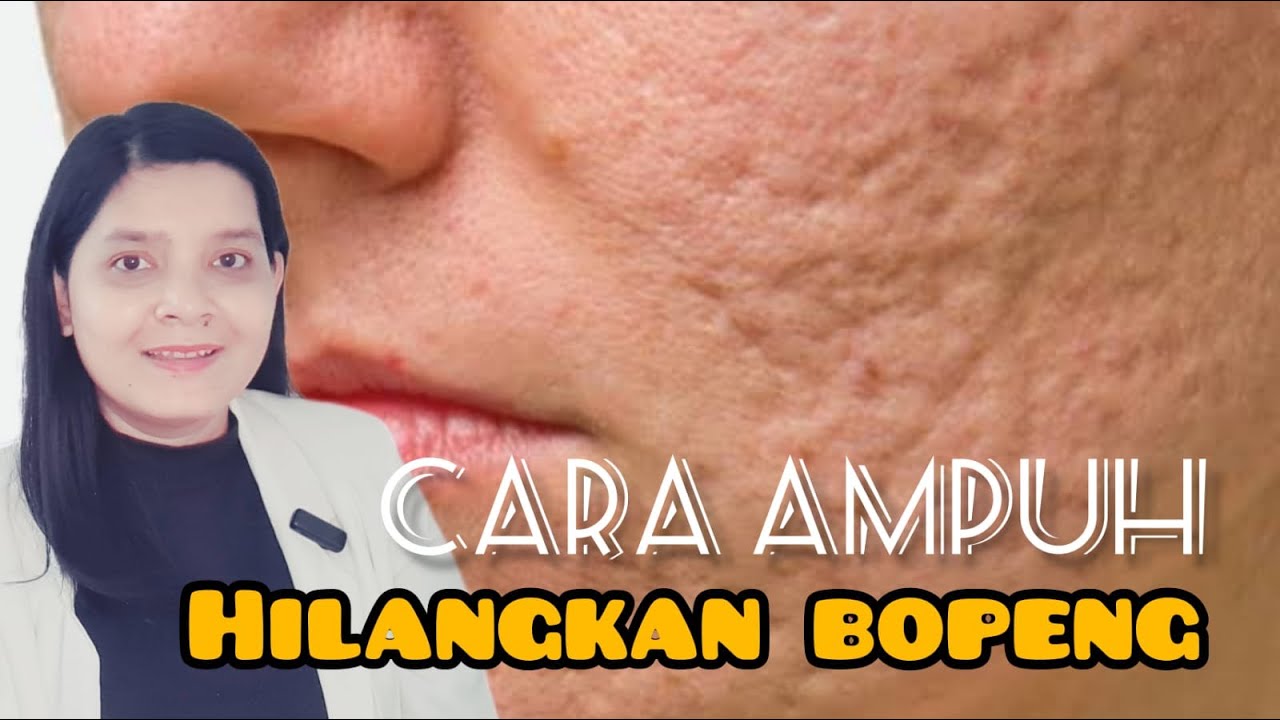 INI LHO, TREATMENT AMPUH HILANGKAN BOPENG! - YouTube