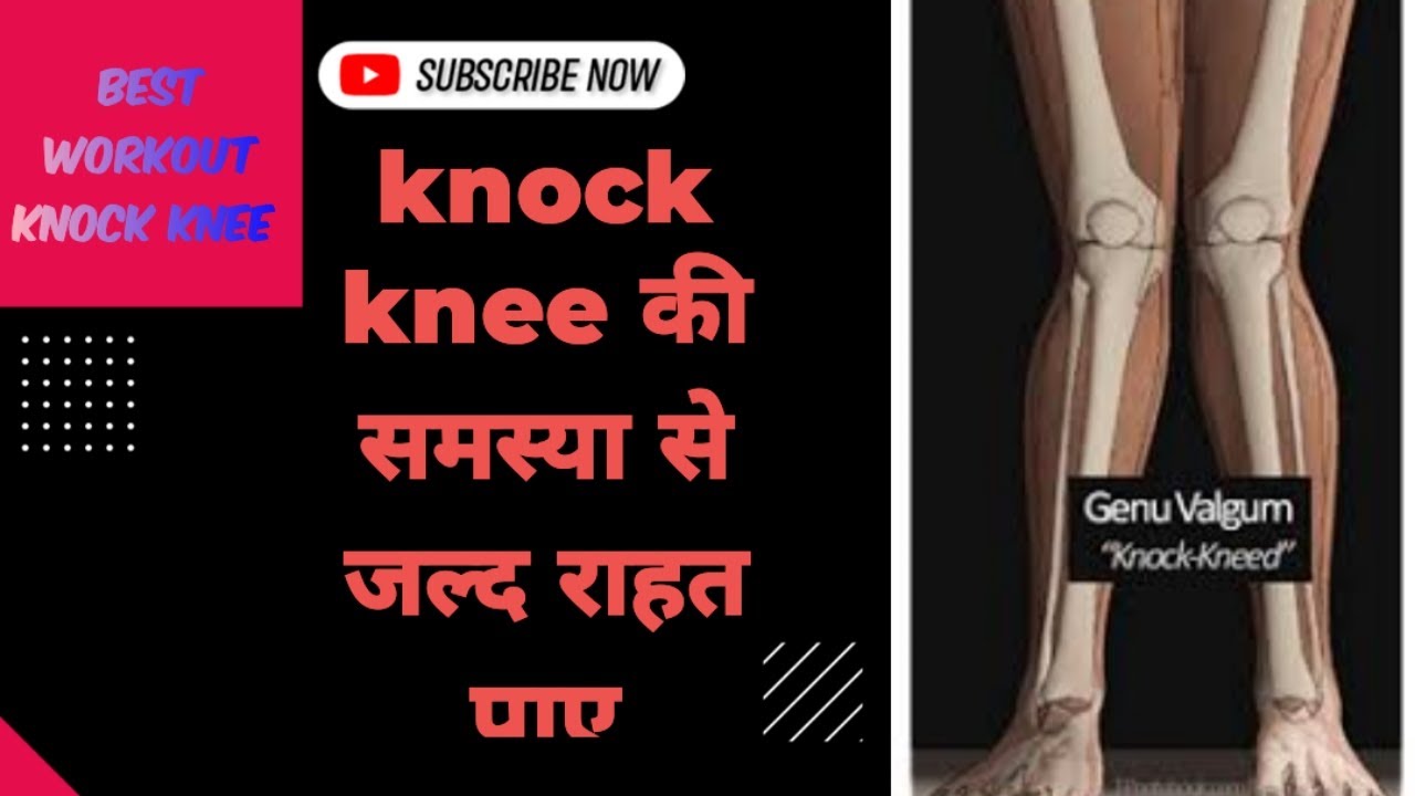 knock knee best exercise | best Home workout tips #youtube #workout # ...