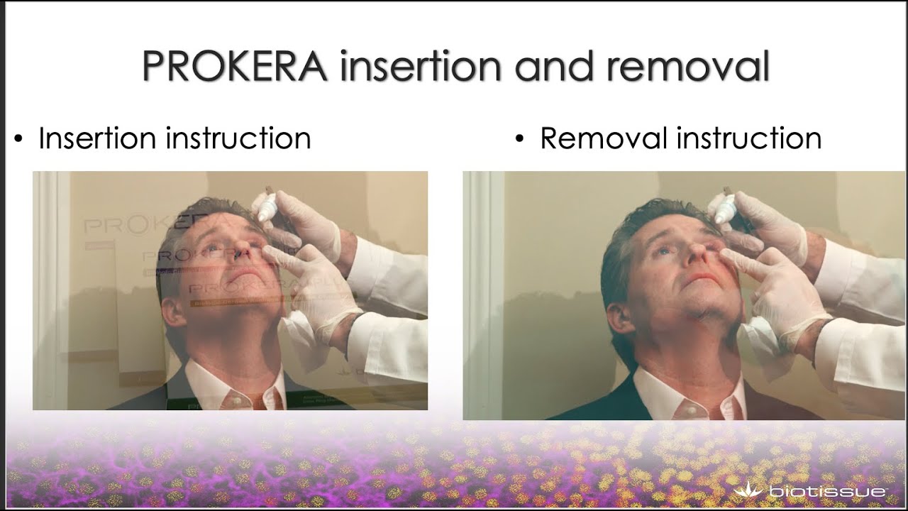 PROKERA® Insertion and Removal - YouTube