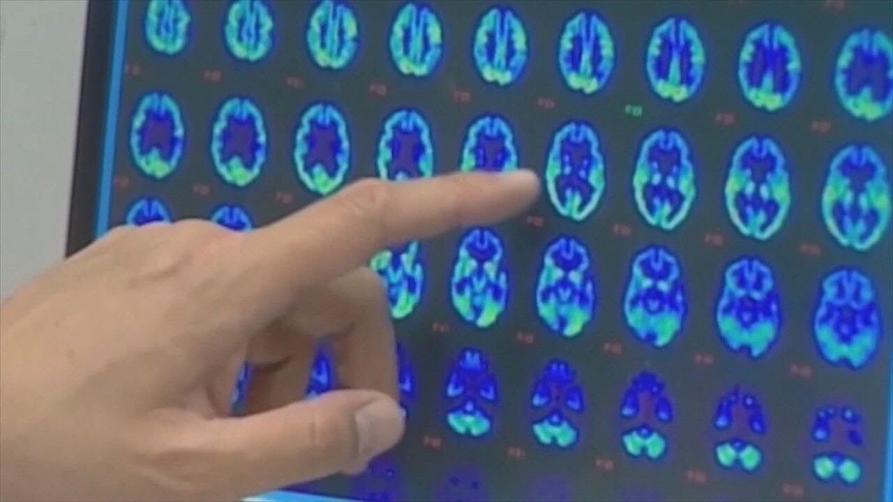 CDC issues warning for parents, doctors about rise in rare brain ...