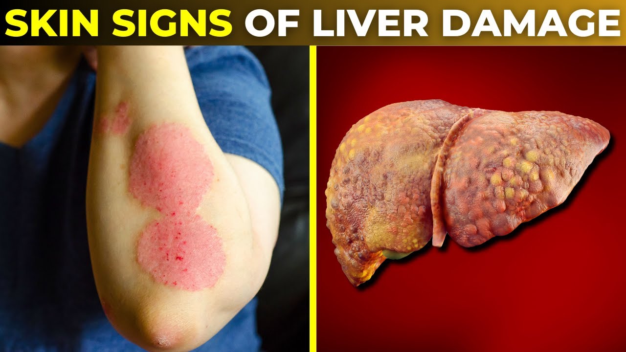 Warning: 12 Skin Signs of Liver Damage You Can't Ignore - YouTube