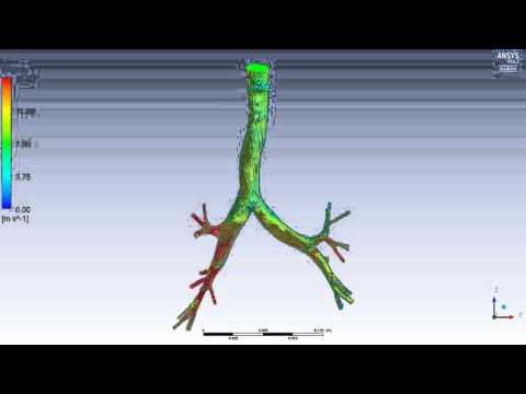 CFD through lung airway affected by COPD - Flow streamlines at the peak ...