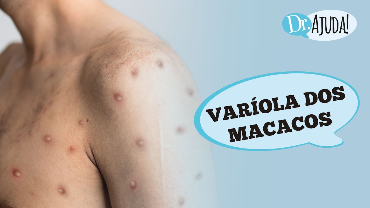 VARÍOLA DOS MACACOS: O QUE É? SINTOMAS? TRANSMISSÃO E PREVENÇÃO - YouTube