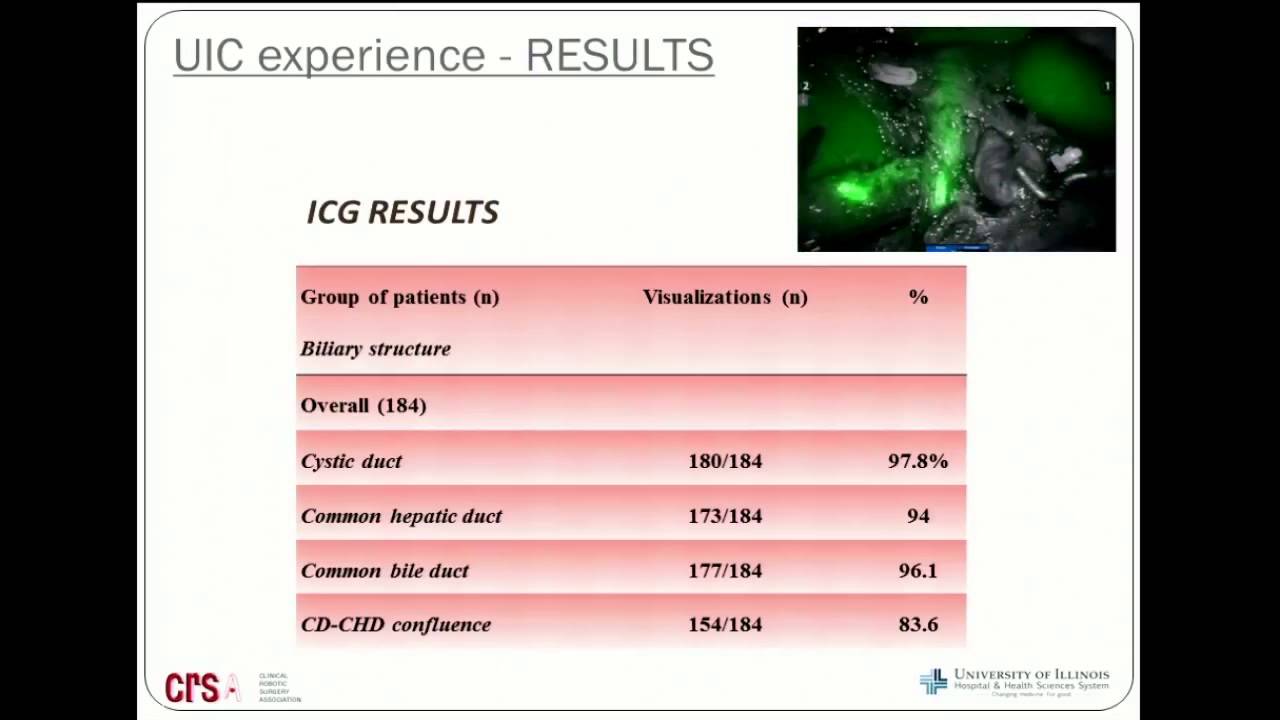 Indocyanine green (ICG) fluorescence robotic cholecystectomy - YouTube