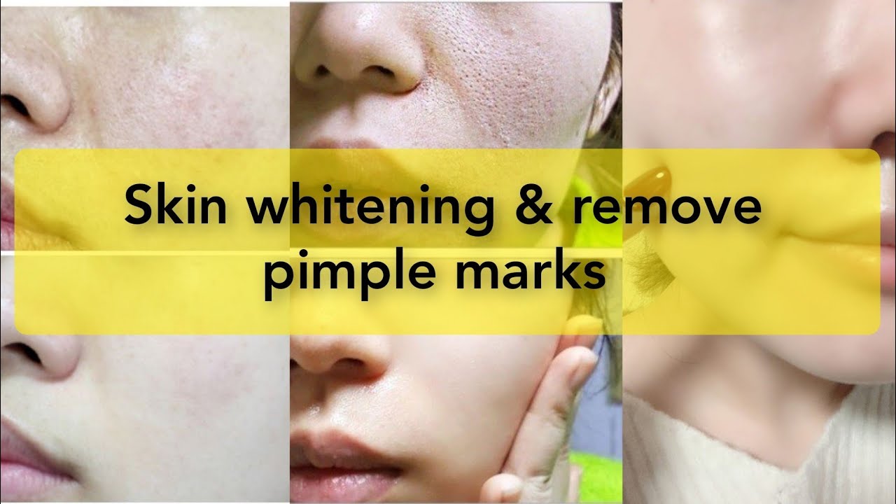 How To Have White Skin | Flawless Skin | How To Get Rid of Pimple Marks ...