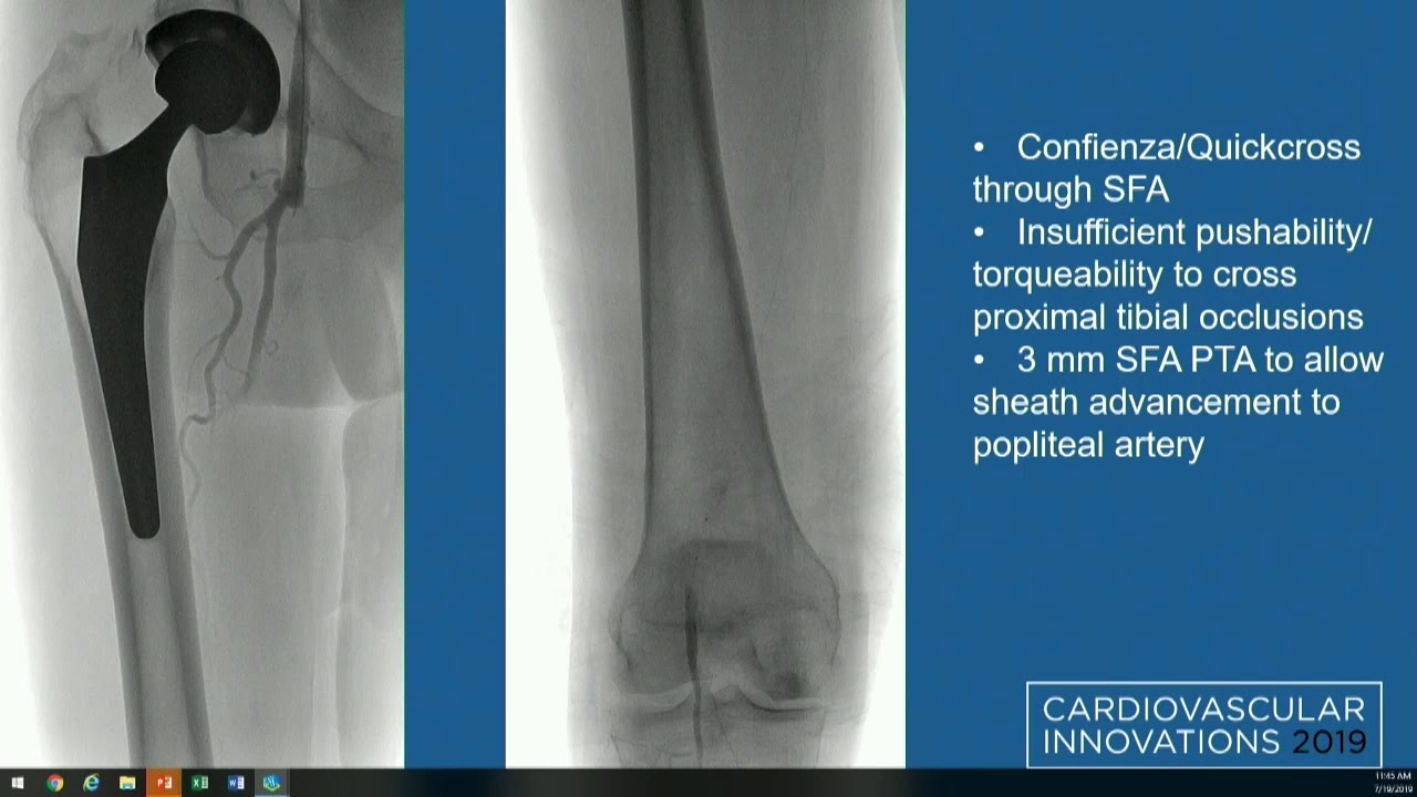 CVI 2019_Friday 7/19_ Common Femoral, SFA, and Popliteal Disease_Alik ...