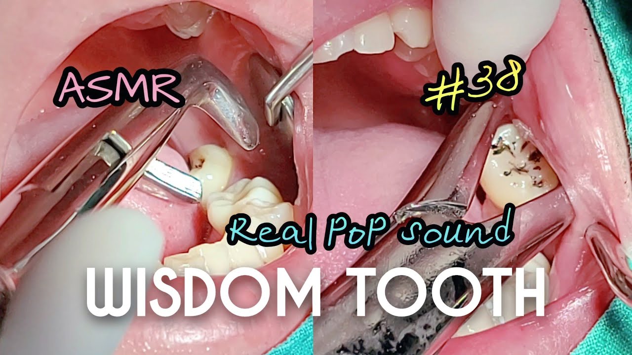 [ASMR] Wisdom Tooth Extraction #real #pop #sound - YouTube