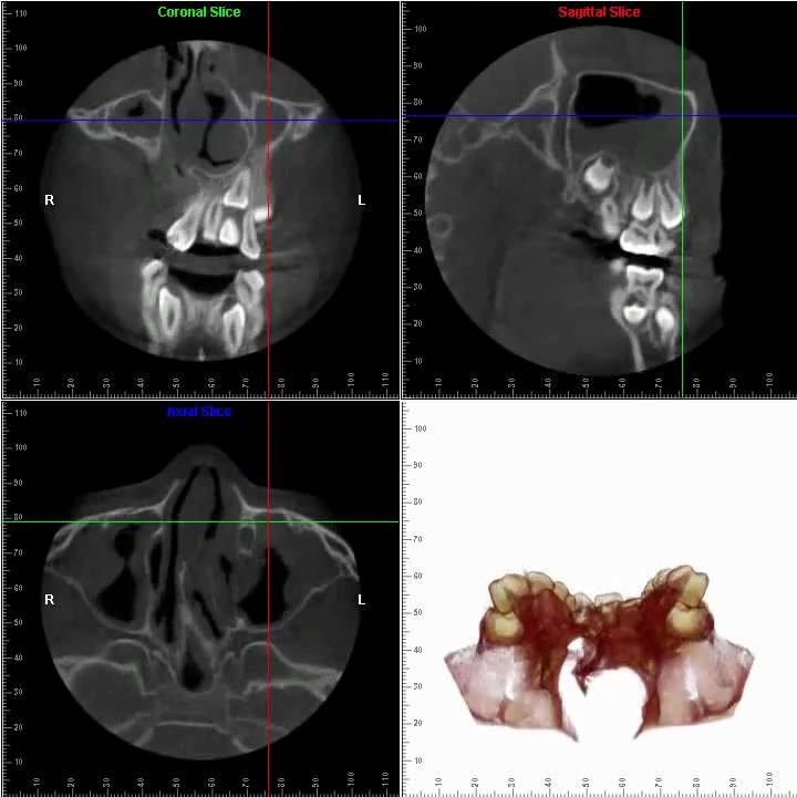 Cleft Palate - 3D Cone Beam CT Scan and Animation by SmartScan Imaging ...