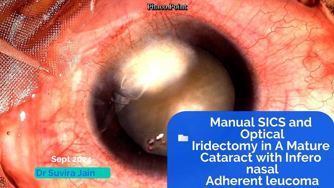 Manual SICS in a Mature Cataract with Optical Iridectomy for an Infero ...