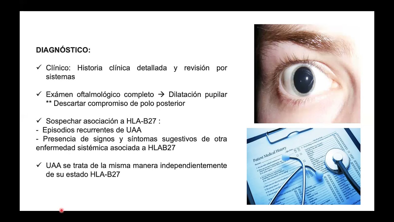 Uveitis asociada a HLA-B27 - YouTube