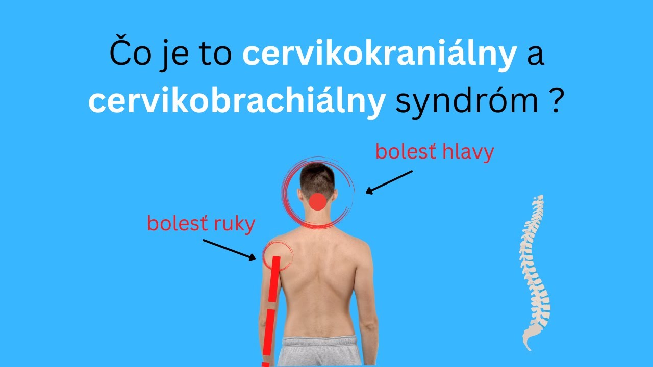 Bolieva vás krčná chrbtica ? Môže isť o tieto dva syndrómy ! - YouTube