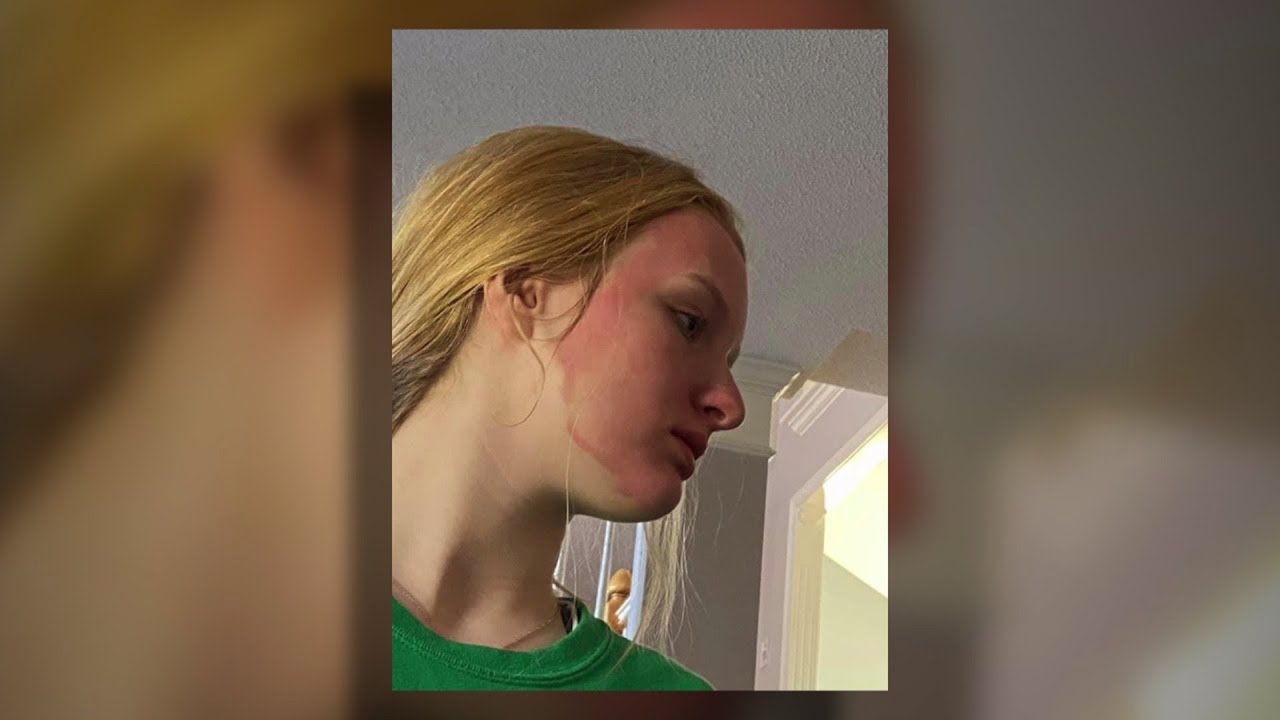 If Its Tingling Its Working Missouri Teen Says Popular Face Mask
