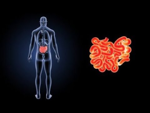 Wat is een liesbreuk en hoe kan dit worden behandeld? - YouTube