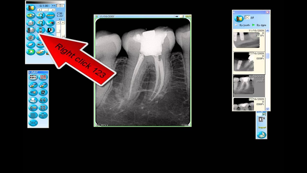 How to sharpen X-ray image in Quickvision 3 - YouTube