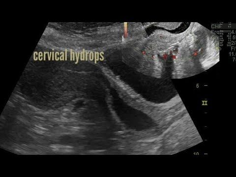 Cervical hydrops or Cervical fluid, ultrasound and color Doppler - YouTube
