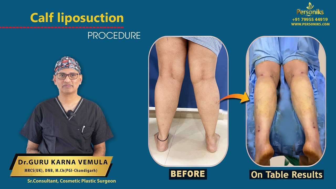 Calf Liposuction procedure @ Personiks by Dr.Gurukarna Vemula - YouTube