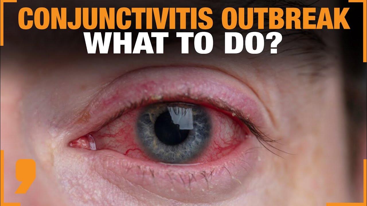 Conjunctivitis Outbreak | Delhi's Rising Eye Infections | How To Prevent Infection | News9 - YouTube