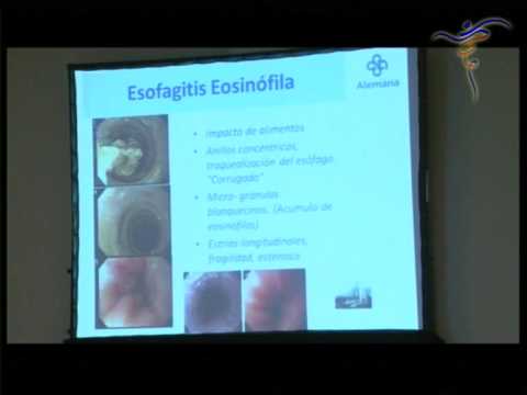 007 esofagitis eosinofilica epidemiologia y manejo - YouTube