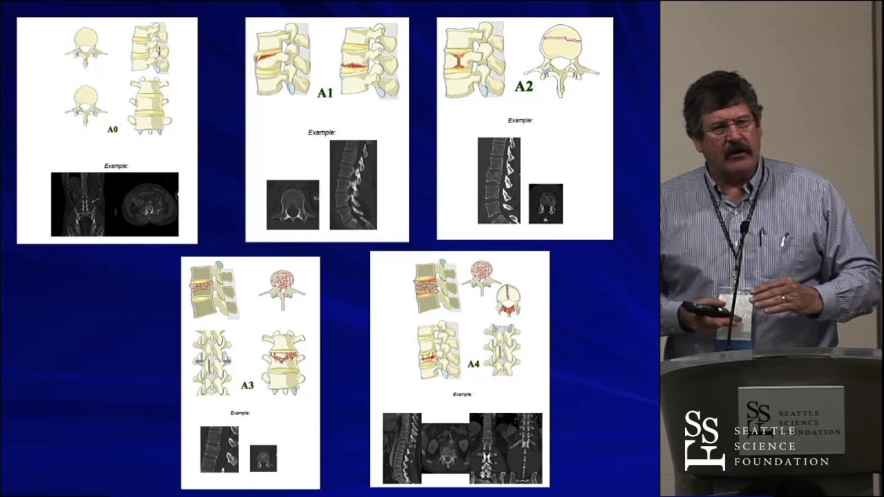 TLICS Vs AO Classification Of Thoracolumbar Fractures John, 51% OFF