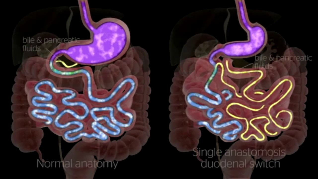 Dr Marcelo Salem - SADI-S / SADS / Duodenal Switch de Anastomose Unica ...