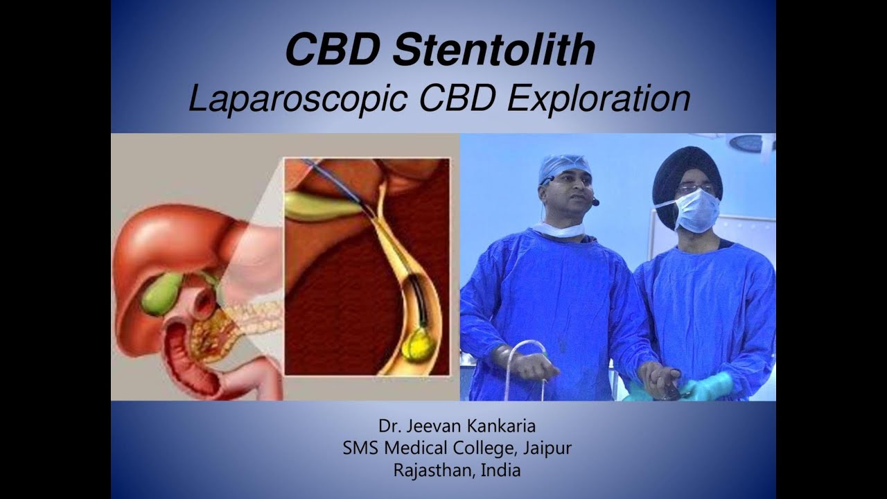 Laparoscopic CBD Exploration In Stentolith (Post Laparoscpic ...