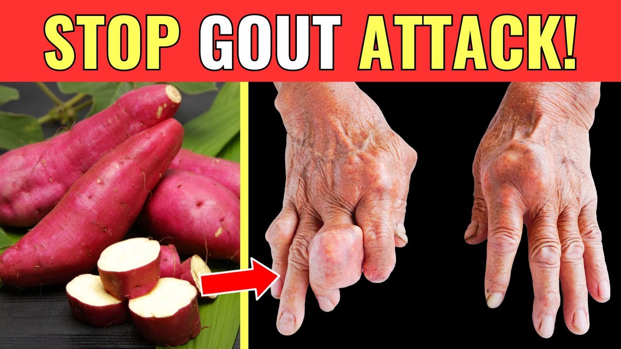 Uric acid Foods to Avoid & Eat | Stop High Uric Acid | Gout | Uric acid ...